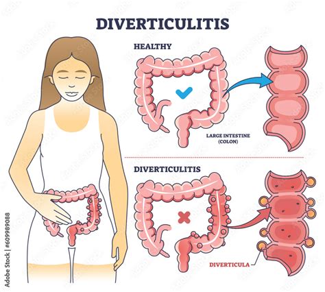 Diverticulitis As Digestive Conditions For Large Intestine Outline Diagram Labeled Educational