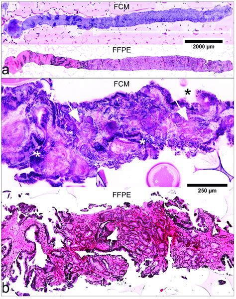 Histological Criteria Of Malignancy In Fcm Images And Ffpe Processed