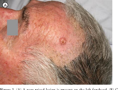Keratoacanthoma