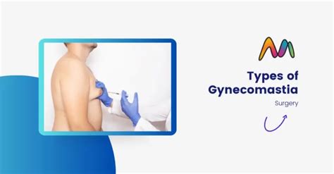 Gynecomastia Surgery And Its Types Which One Is Right For You