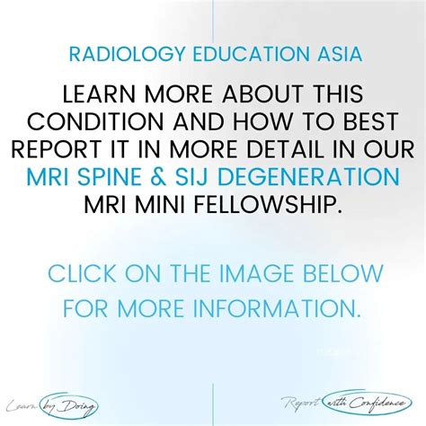 Pars Defect Radiology Mri Radiology Education Asia
