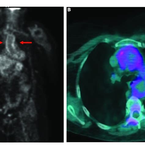 Total Body 18f Fluorodeoxyglucose Positron Emission Tomography Computed Download Scientific