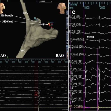 Non Selective His Bundle Pacing In Patient No 7 Paroxysmal Atrial Download Scientific Diagram