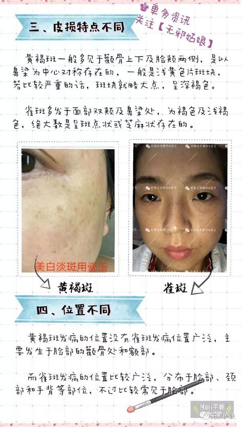 脖子长黑斑图片脖子上长斑图片脖子上长黑斑第4页大山谷图库