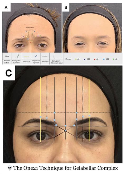 💀 Schematic Mapping Of The One21 Technique For Treating The Procerus Pm Corrugators Csm