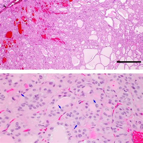 Upper Panel Oncocytic Noninvasive Encapsulated Follicular Variant Of Download Scientific