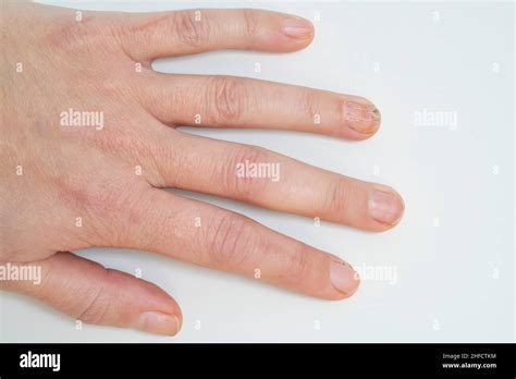 Fungus Closeup Nail Fungus Infection On Hand Finger Of White Caucasian