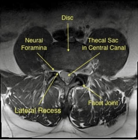 Lumbar Spine Mri Axial Explaining Spinal Disorders Lumbar Spinal