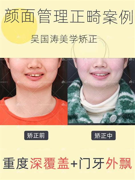 合肥牙齿矫正丨隐适美二次矫正 重度深覆盖门牙严重外飘开唇露齿 知乎