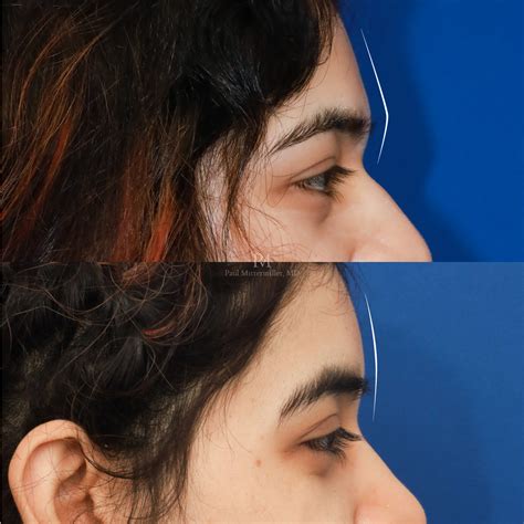 Brow Bone Reduction Before After 240521 4mo Paul Mittermiller Md