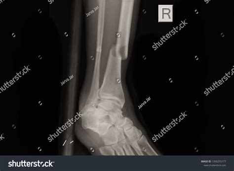 Xray Image Show Closed Fracture Right Stock Photo Shutterstock