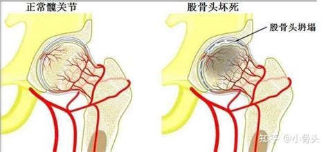 髋部骨髓水肿就一定是股骨头坏死吗？ 知乎