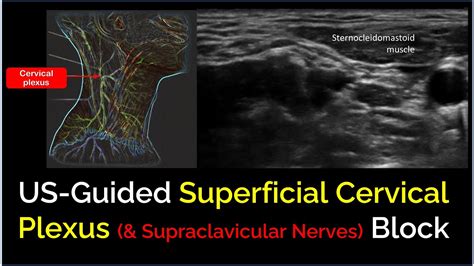 Superficial Cervical Plexus Block A How To Guide Youtube