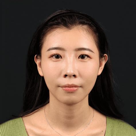 自體脂肪補臉介紹、ptt Dcard 網友自體脂肪補臉疑問解答 莎斐爾整形外科診所