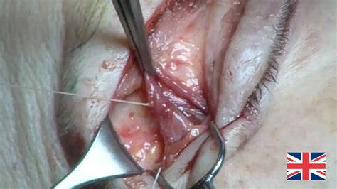 Midface Lifting Surgery Medplus