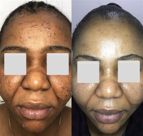 Acne Scars Before And After Chemical Peel