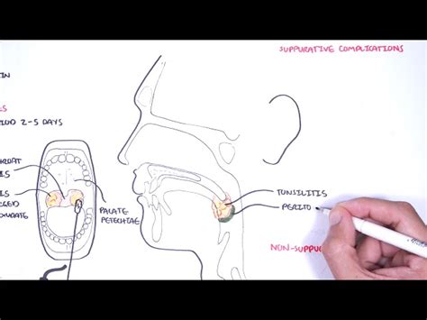 Streptococcal Pharyngitis Diagram