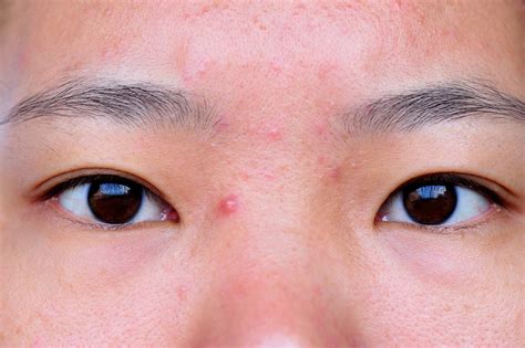 Here S How To Cover Every Type Of Pimple Allure