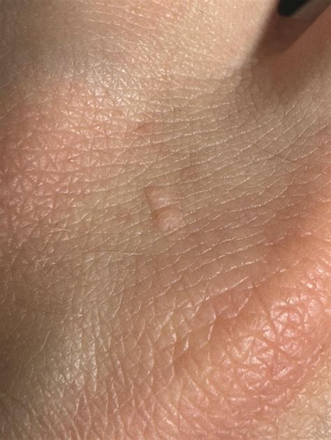Weird Bumps On Top Of My Hand Rdermatologyquestions