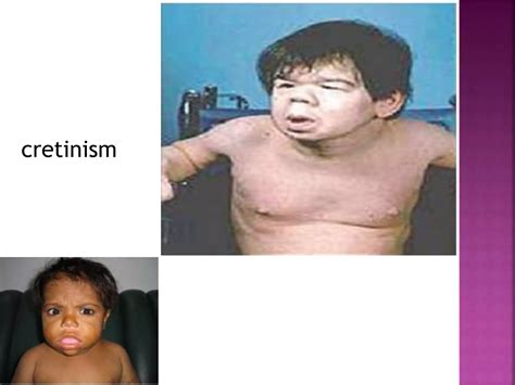Hypothyroidism Ppt