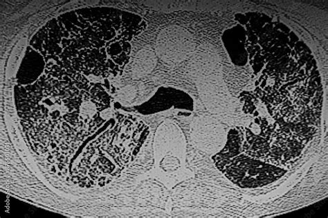 Cat Scan Of Interstitial Lung Disease Secondary To Scleroderma