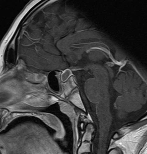 Xanthomatous Hypophysitis Neuroimaging Of Hypophysitis Etiologies And