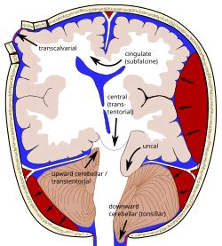 Uncal Herniation Cranial Nerve 3