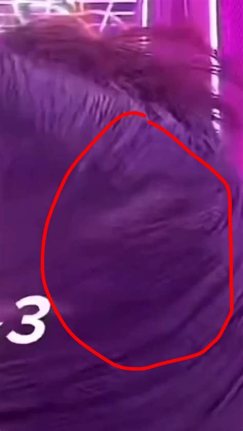 Nitty Nora 🪳 You Can See The Nit Go From Strand To Strand But People