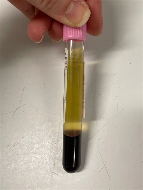 Red Blood Cells Lipemia Professional Education