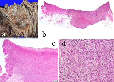 Colectomy Hepatic Flexure Mass Hematoxylin And Eosin Stain A The