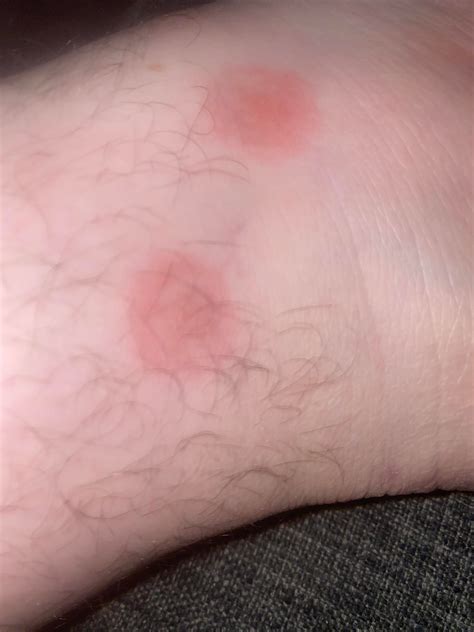 Red Circles On Skin Any Idea What This Could Be Rdiagnoseme