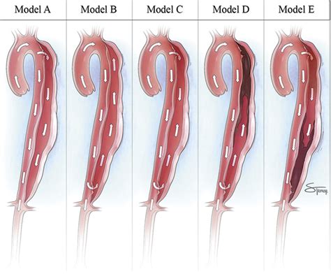 Anatomic Subtypes Of Acute Type B Aortic Dissection Model A Single