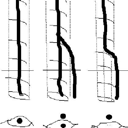 Anterior Accessory Saphenous Vein AASV And The Alignment Sign A Download Scientific