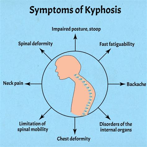 Kyphosis Dr Mahmood Ahmad