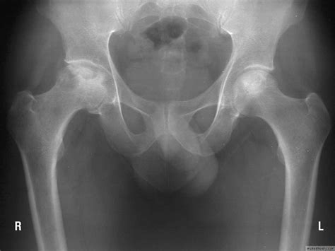 Complications Of Fractures Pptx D Haider Muhadharaty
