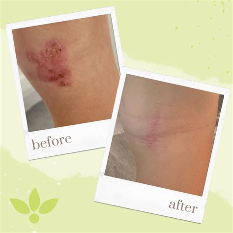 Eczema Relief Bundle Honeoye Remedies