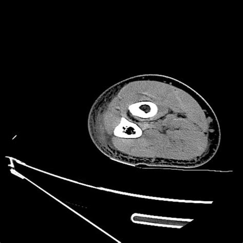 Left Elbow Ct Scan Upper Extremity Cts
