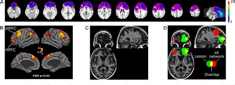 Figure 2 From Lesions To The Fronto Parietal Network Impact Alpha Band Phase Synchrony And