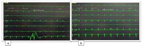 Intraoperative Ecg With Normal Lead Placement A And Reversal Of Leads B Download
