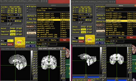 Sswarper Frontal Clipping Afni Message Board Afni Discuss Message Board