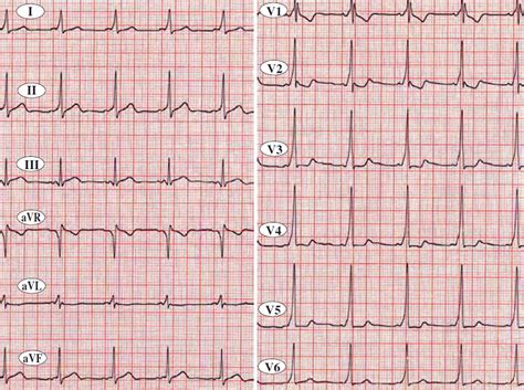 Kents Bundle Localization In Wpw Ecg Book