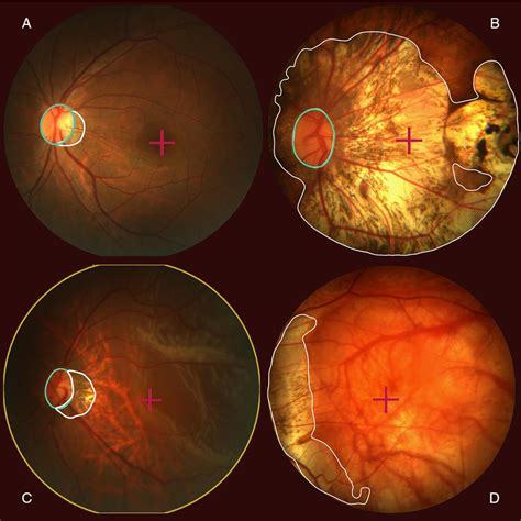 figure 2 from pathological myopia classification with simultaneous lesion segmentation using