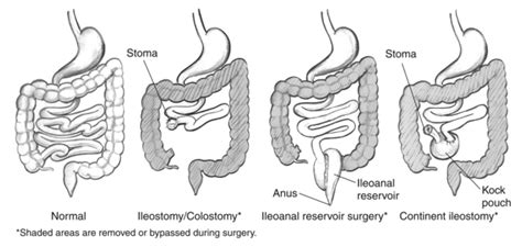 Loop Ileostomy Diagram