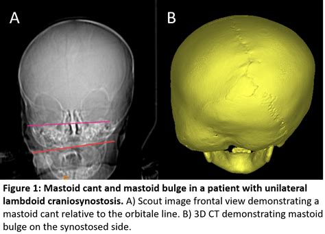 Bilateral Lambdoid Synostosis