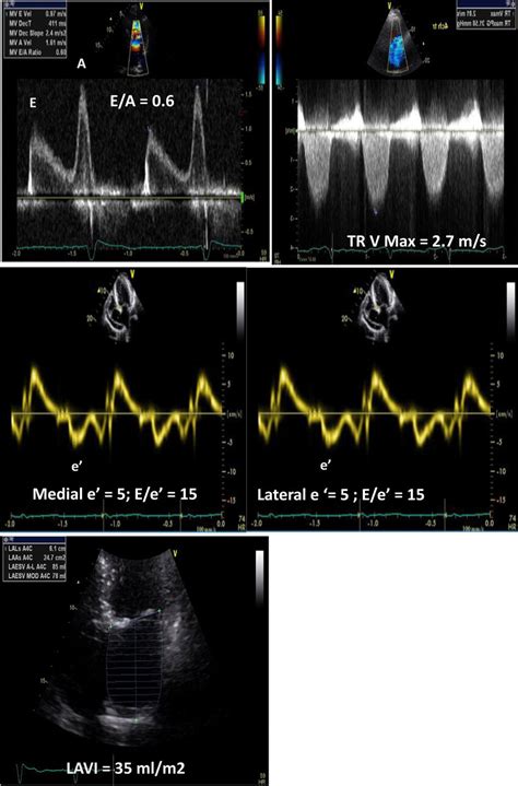 Grade 1 Diastolic Dysfunction 75 Year Old Male With Hypertensive Heart Download Scientific
