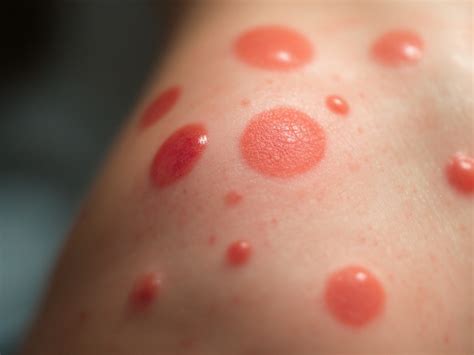 Erythema Annulare Centrifugum Md Searchlight