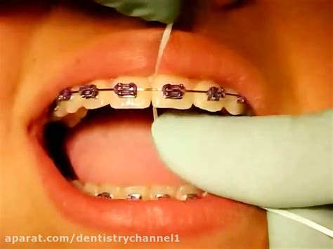 روش استفاده از نخ دندان در ارتودنسی