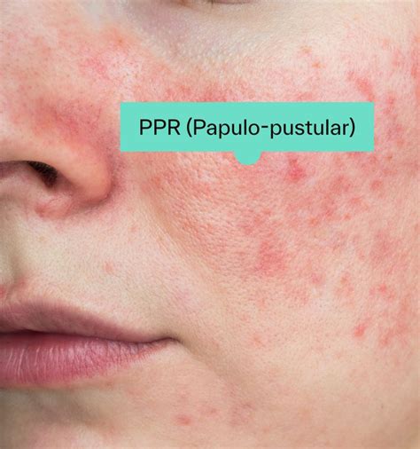 Rosacea Treatment Rosacea Treatment Rosacea Treatment Rosacea Treatment