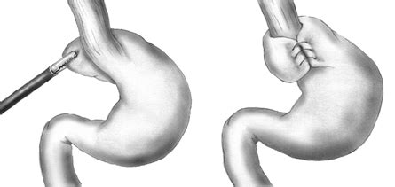 Nissen Fundoplication Ucsf Department Of Surgery