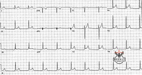 Ecg